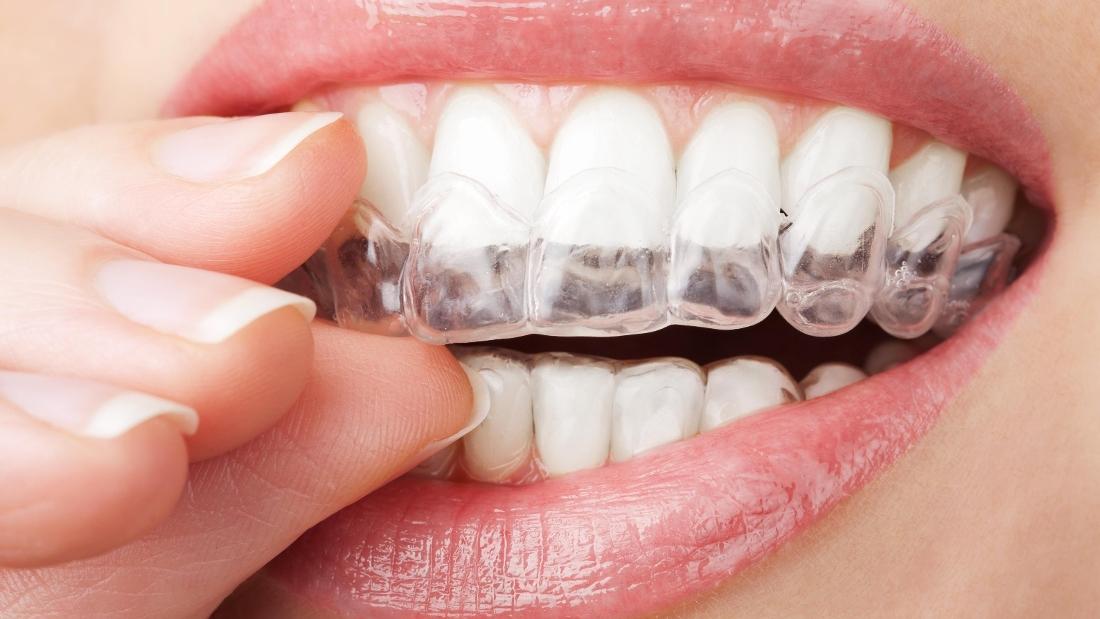Invisalign Open Day & The Benefits of Invisalign | Coffs Harbour